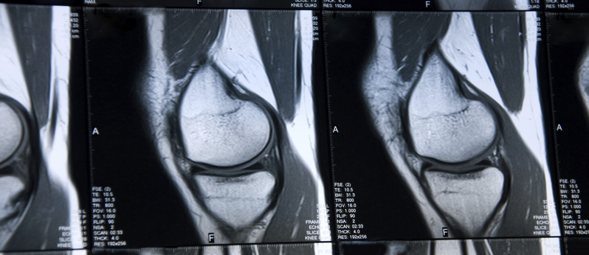 Quantitative MRI Imaging in Orthopedic Clinical Trials | WCG